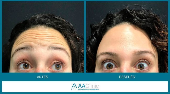 Antes Y Después Botox Aa Clinic