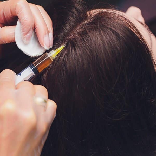 PRP Capilar - AA Clinic