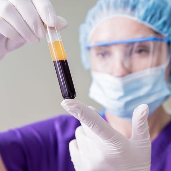 PRP Capilar - AA Clinic